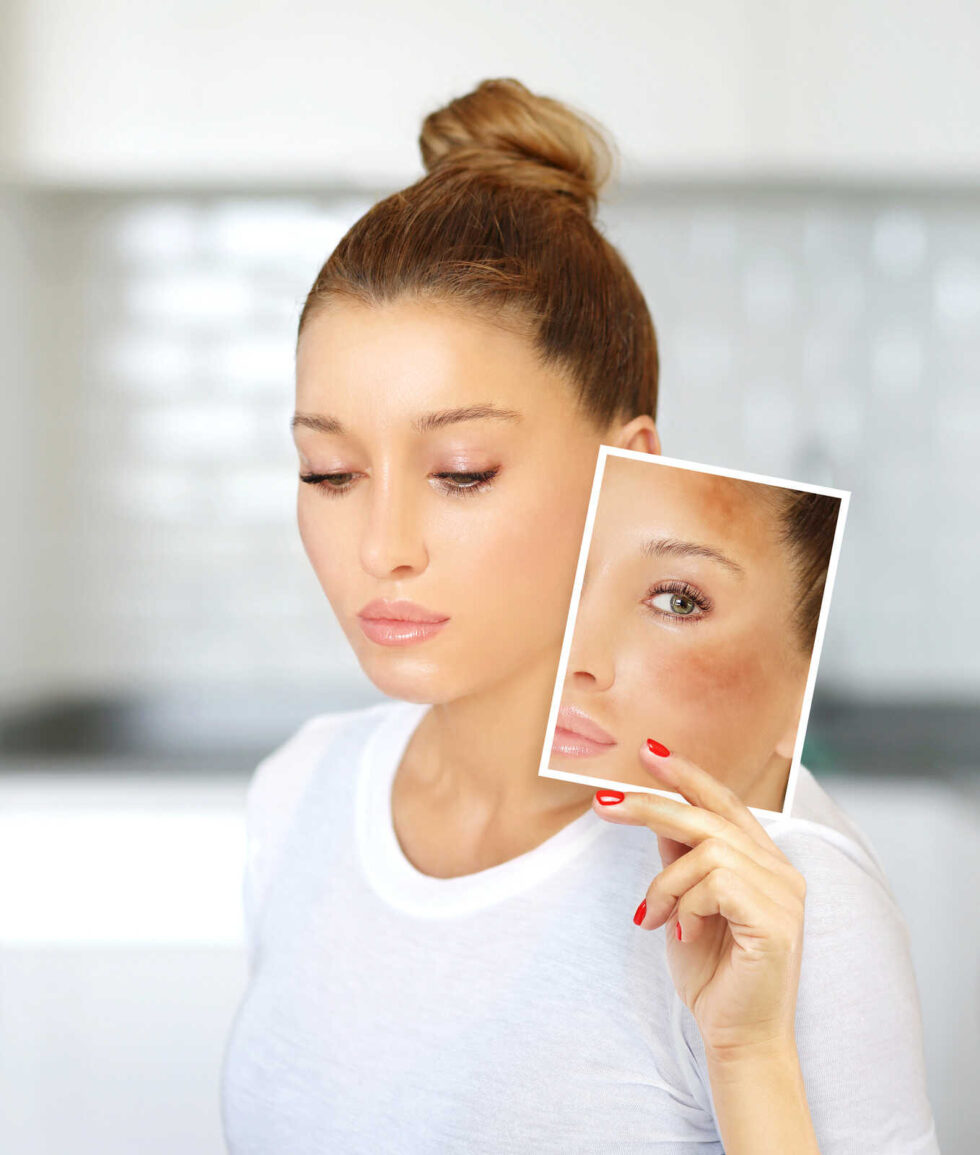 Melasma Treatment ( Hyperpigmentation ) At Ayuva Clinic