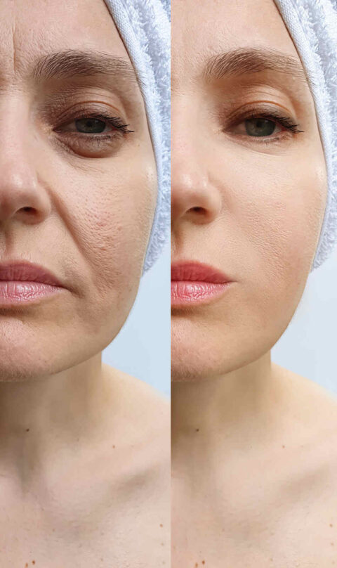 Wrinkle Reduction Treatment At Ayuva Skin & Hair Clinic